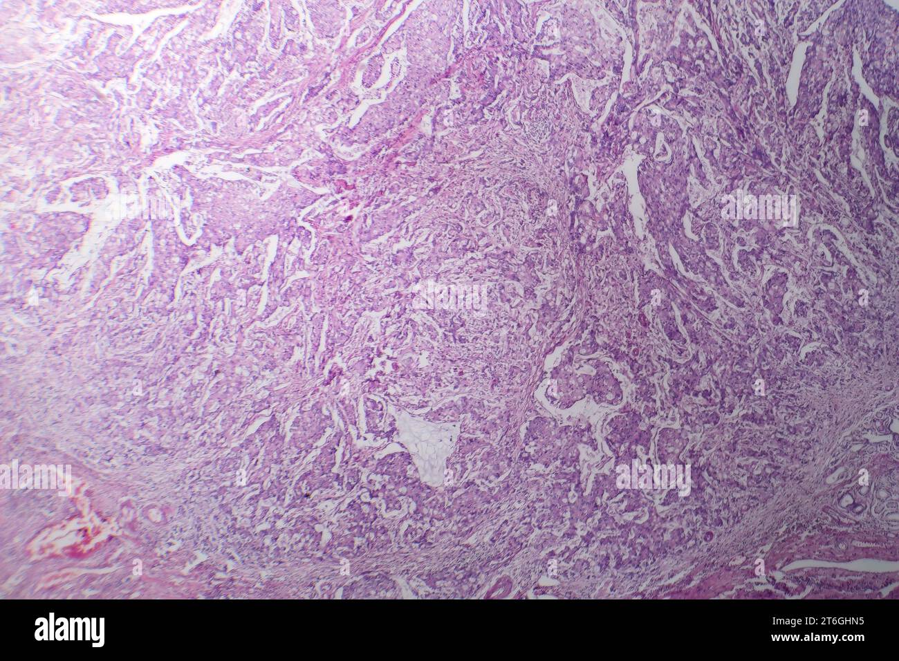 Photomicrograph of mucinous carcinoma in the stomach, displaying ...