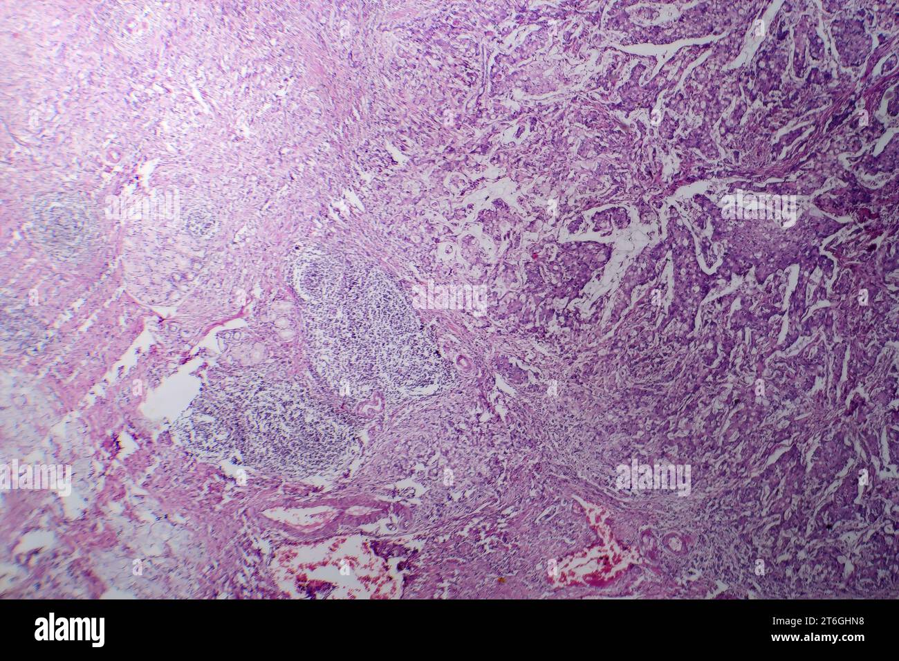 Photomicrograph of mucinous carcinoma in the stomach, displaying ...