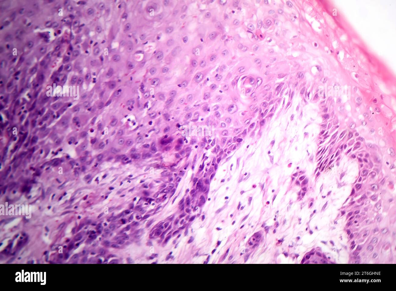 Photomicrograph of mucinous carcinoma in the stomach, displaying ...