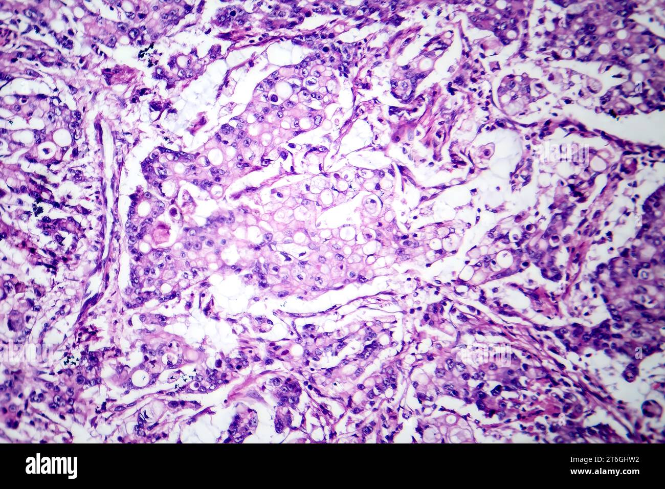 Photomicrograph of mucinous carcinoma in the stomach, displaying ...