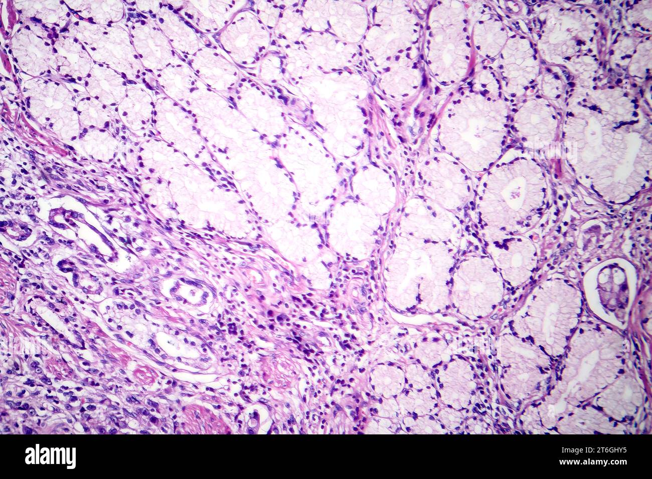 Photomicrograph of mucinous carcinoma in the stomach, displaying ...
