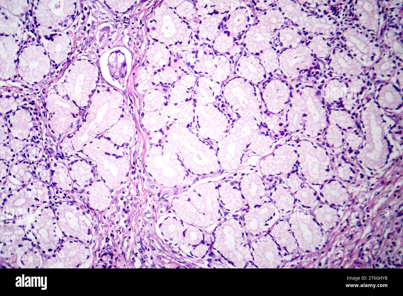 Photomicrograph of mucinous carcinoma in the stomach, displaying ...