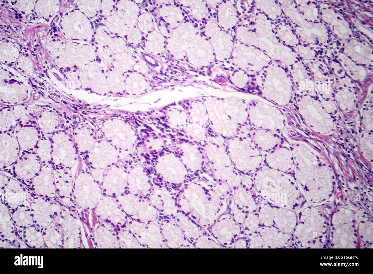 Photomicrograph of mucinous carcinoma in the stomach, displaying ...