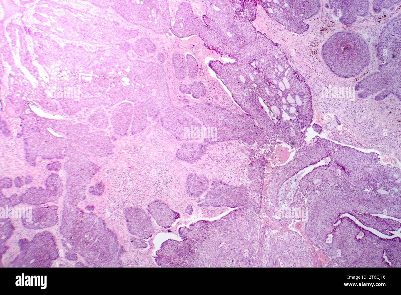 Photomicrograph of basal cell carcinoma, displaying malignant basal ...