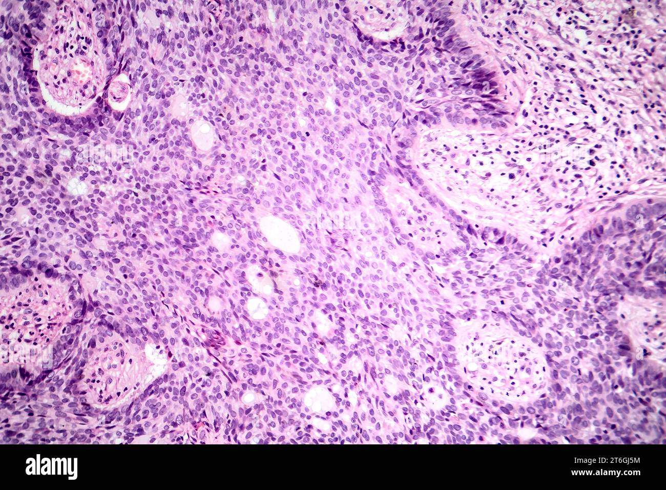Photomicrograph Of Basal Cell Carcinoma Displaying Malignant Basal