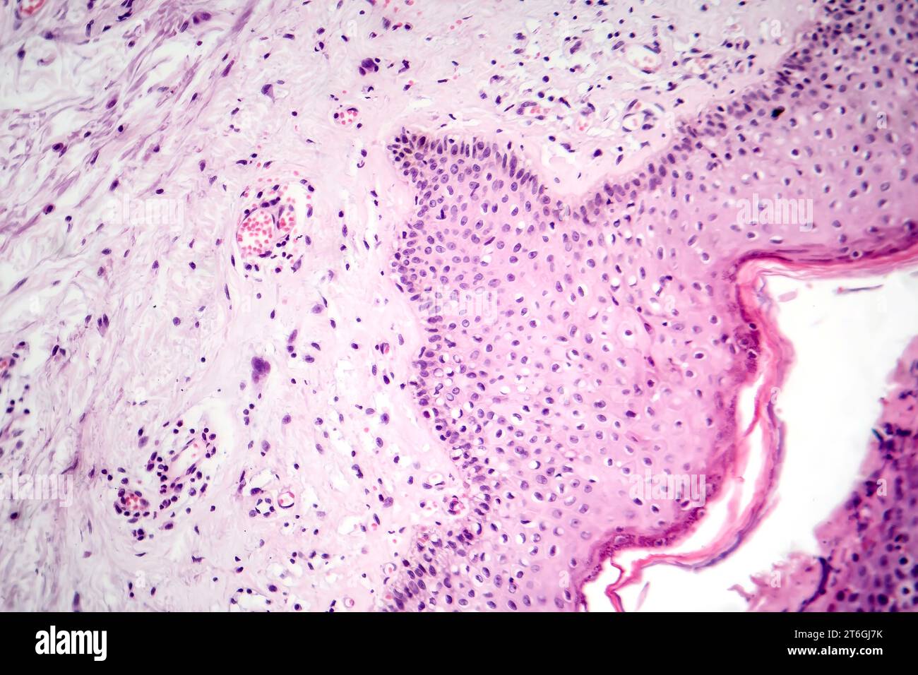 Photomicrograph of basal cell carcinoma, displaying malignant basal ...