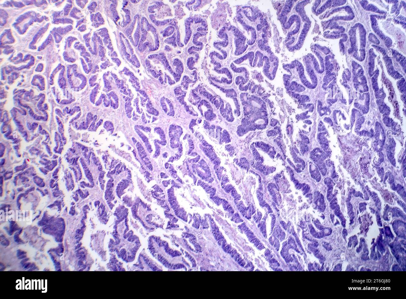 Photomicrograph of esophageal squamous cell carcinoma, showing ...