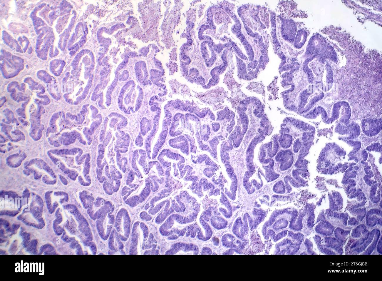 Photomicrograph of esophageal squamous cell carcinoma, showing ...
