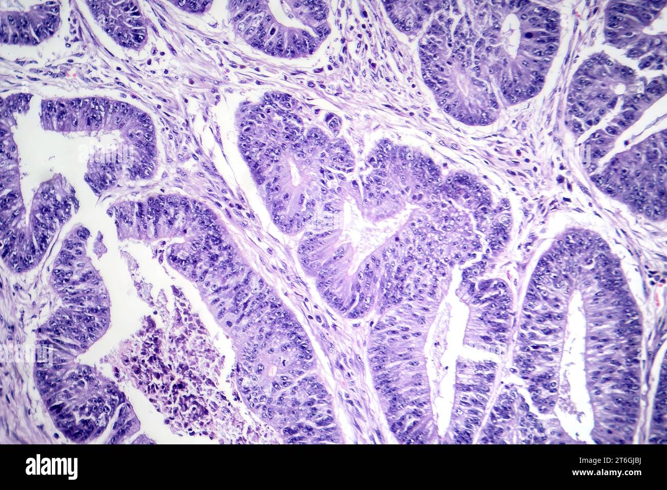 Photomicrograph of esophageal squamous cell carcinoma, showing ...