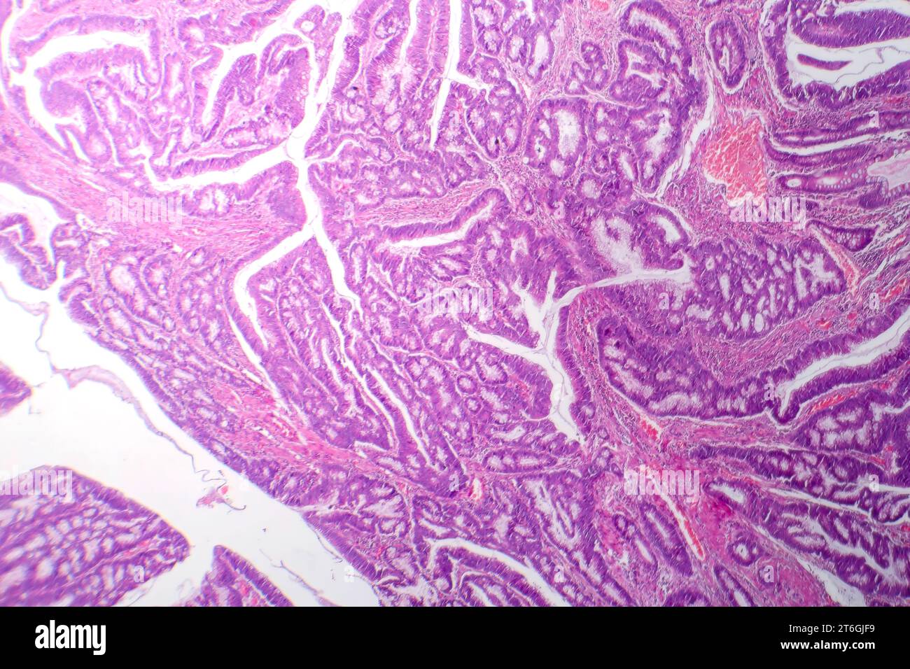 Photomicrograph of colon adenocarcinoma, illustrating malignant ...