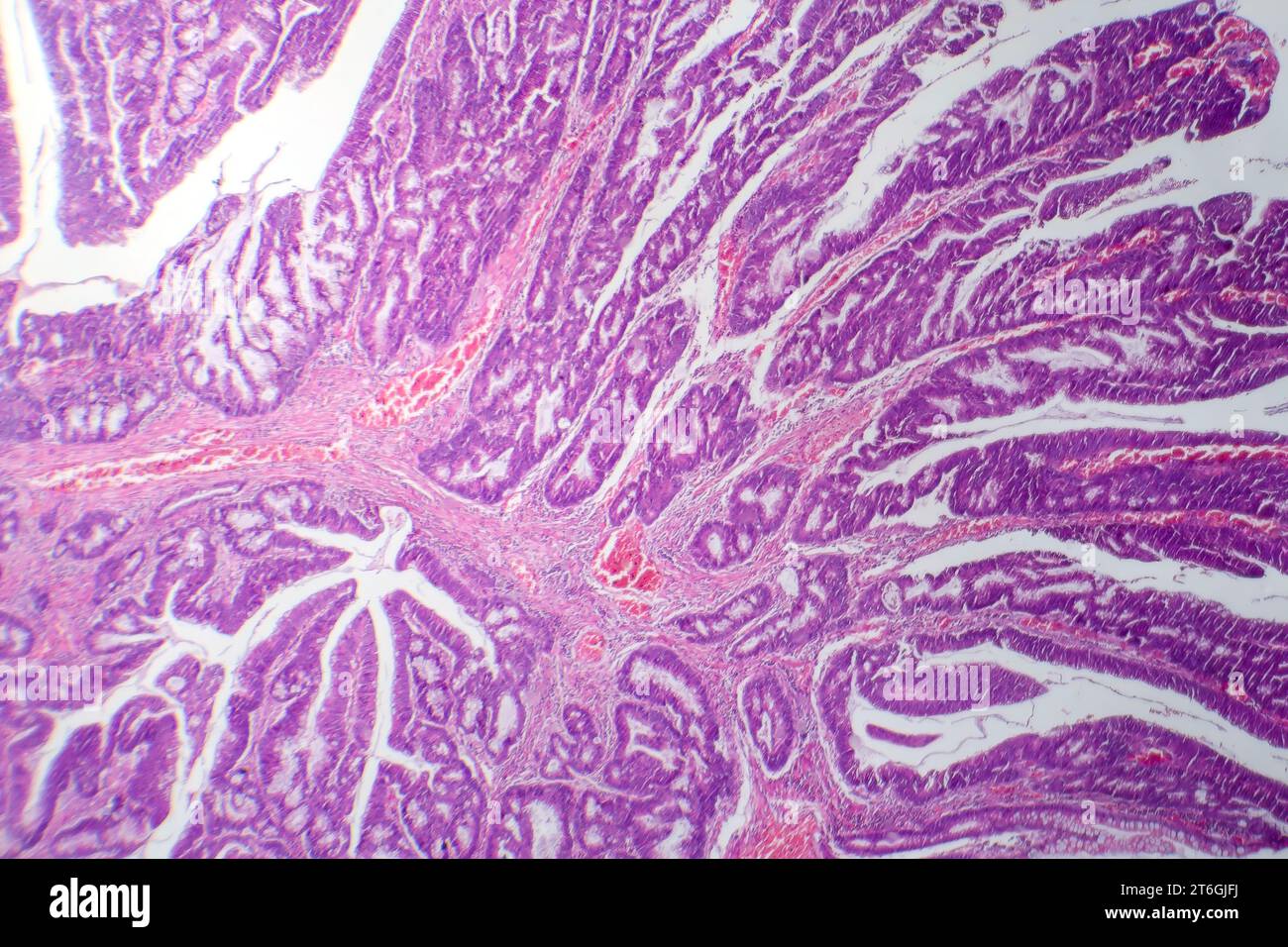 Photomicrograph of colon adenocarcinoma, illustrating malignant ...
