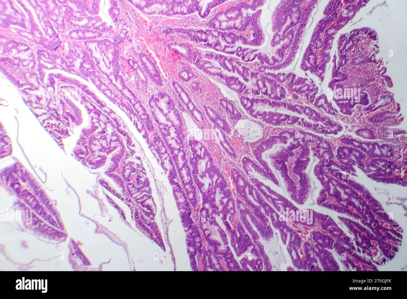 Photomicrograph of colon adenocarcinoma, illustrating malignant ...