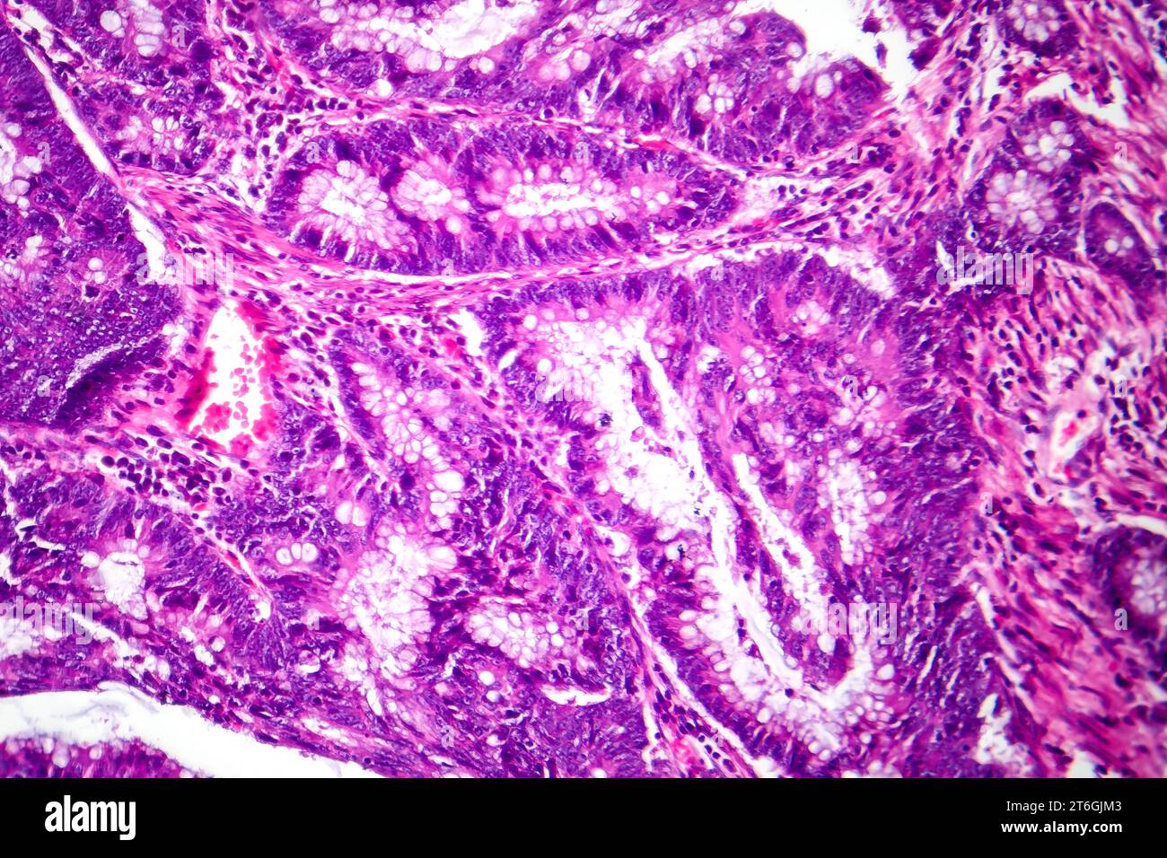 Photomicrograph Of Colon Adenocarcinoma Illustrating Malignant Glandular Cells Characteristic
