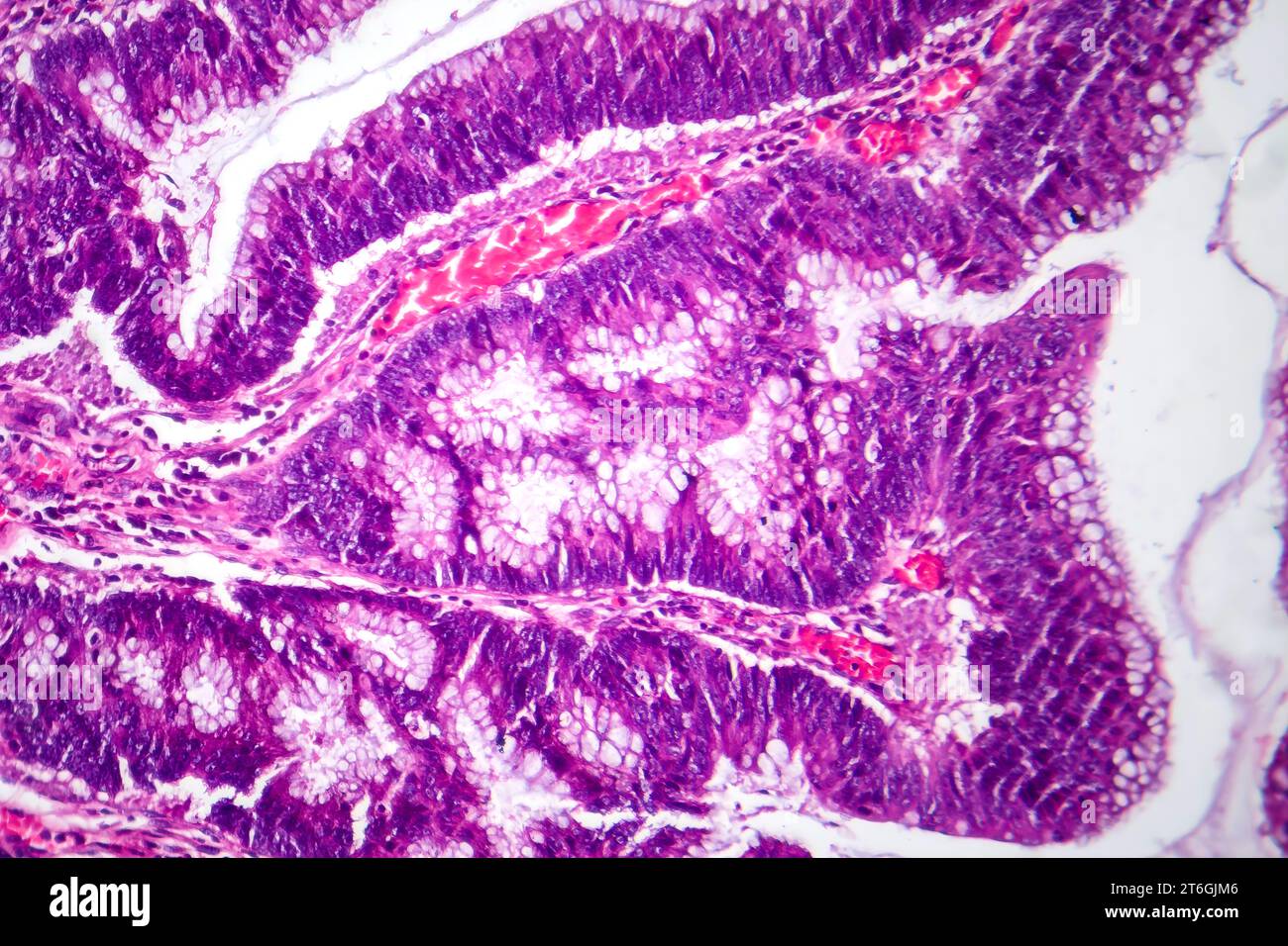 Photomicrograph of colon adenocarcinoma, illustrating malignant ...