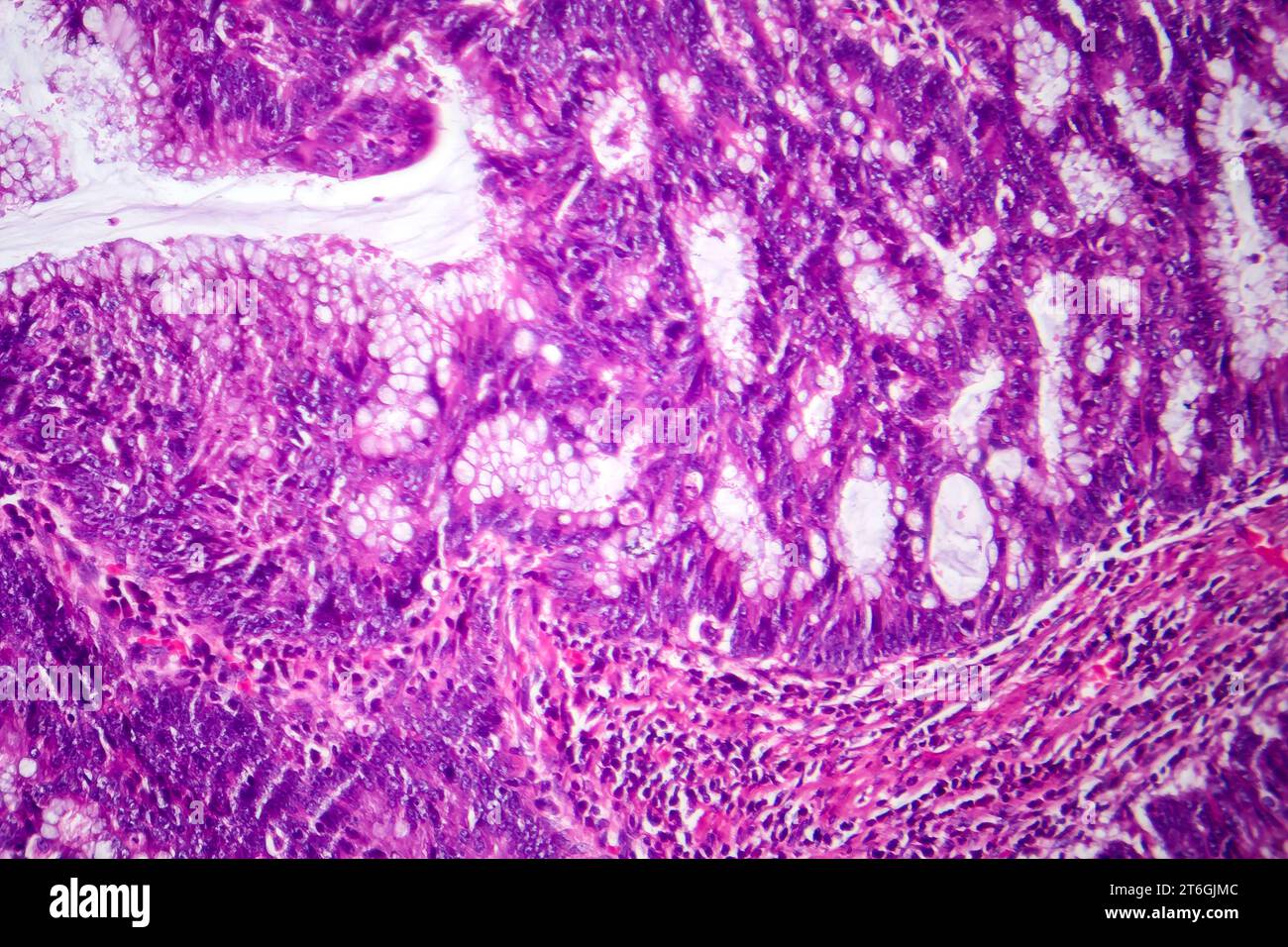 Photomicrograph Of Colon Adenocarcinoma Illustrating Malignant Glandular Cells Characteristic
