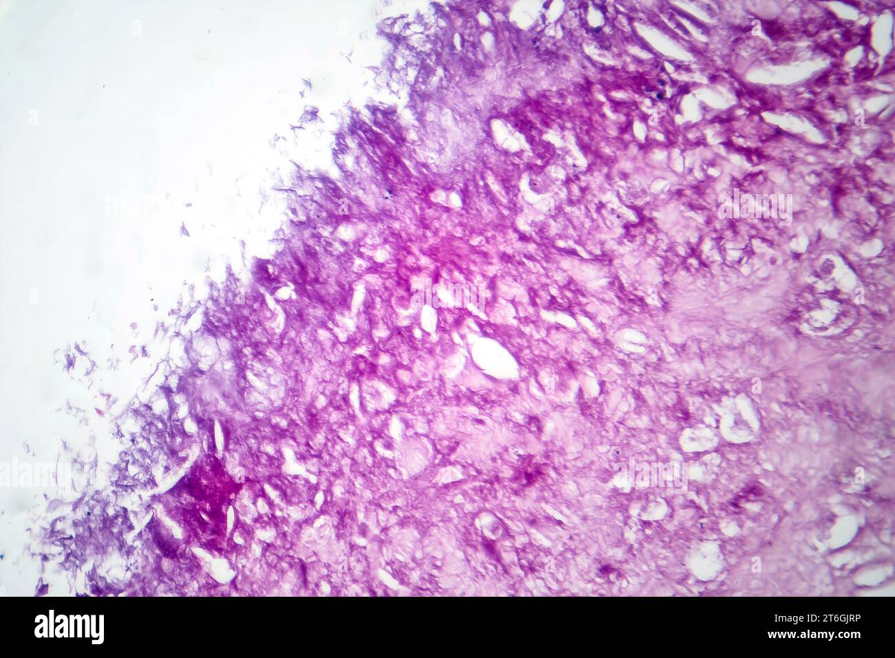 Photomicrograph of melanoma, showcasing malignant melanocytes, the ...