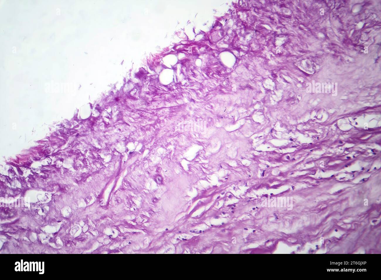 Photomicrograph of melanoma, showcasing malignant melanocytes, the ...
