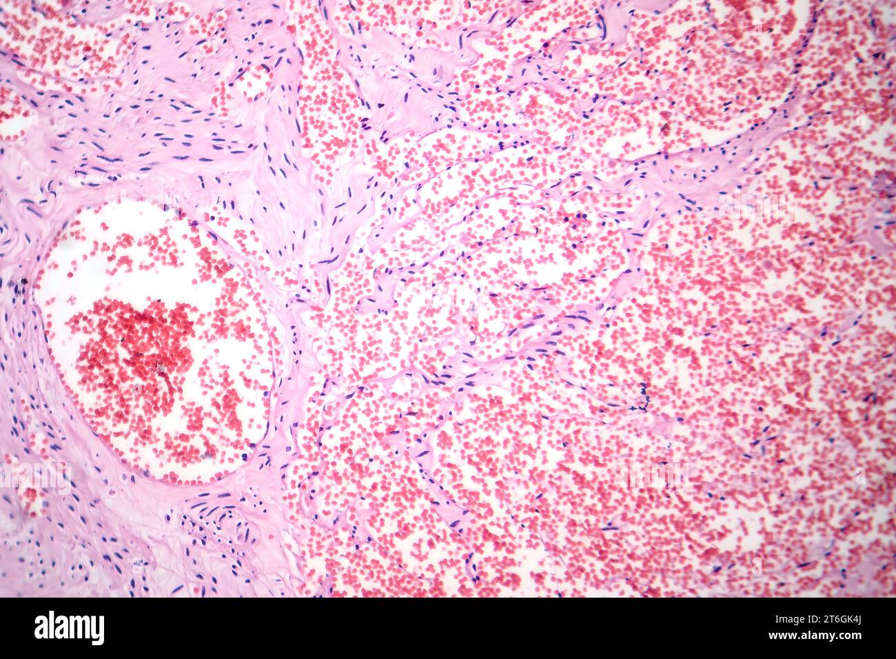Photomicrograph Of Capillary Hemangioma Illustrating Abnormal