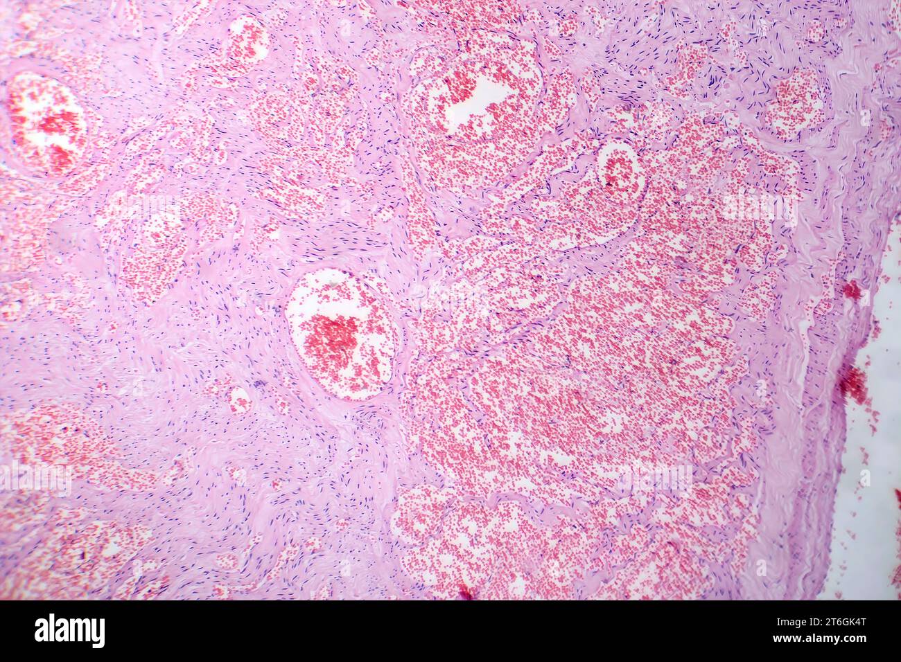Photomicrograph of capillary hemangioma, illustrating abnormal ...