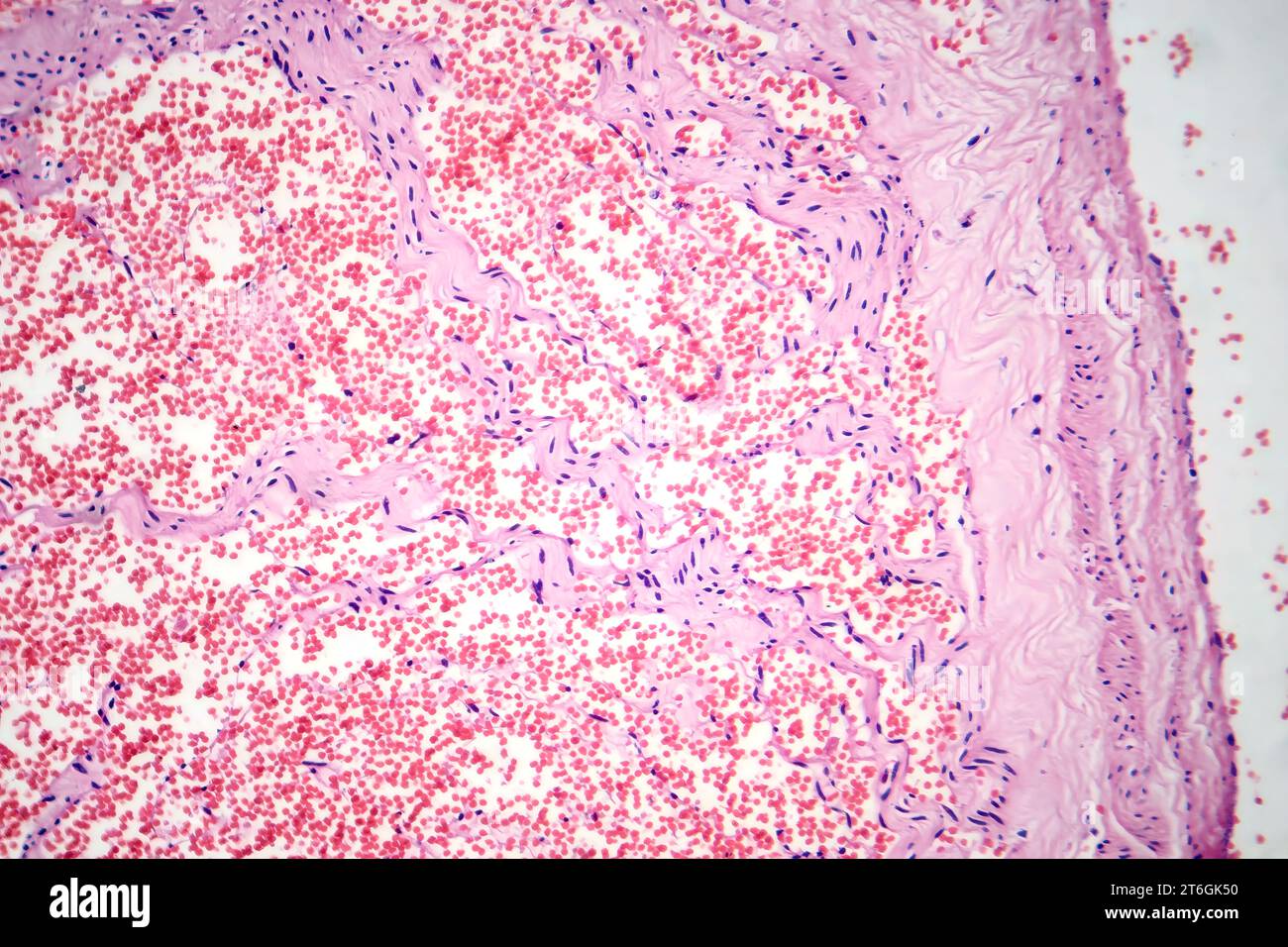 Photomicrograph of capillary hemangioma, illustrating abnormal ...