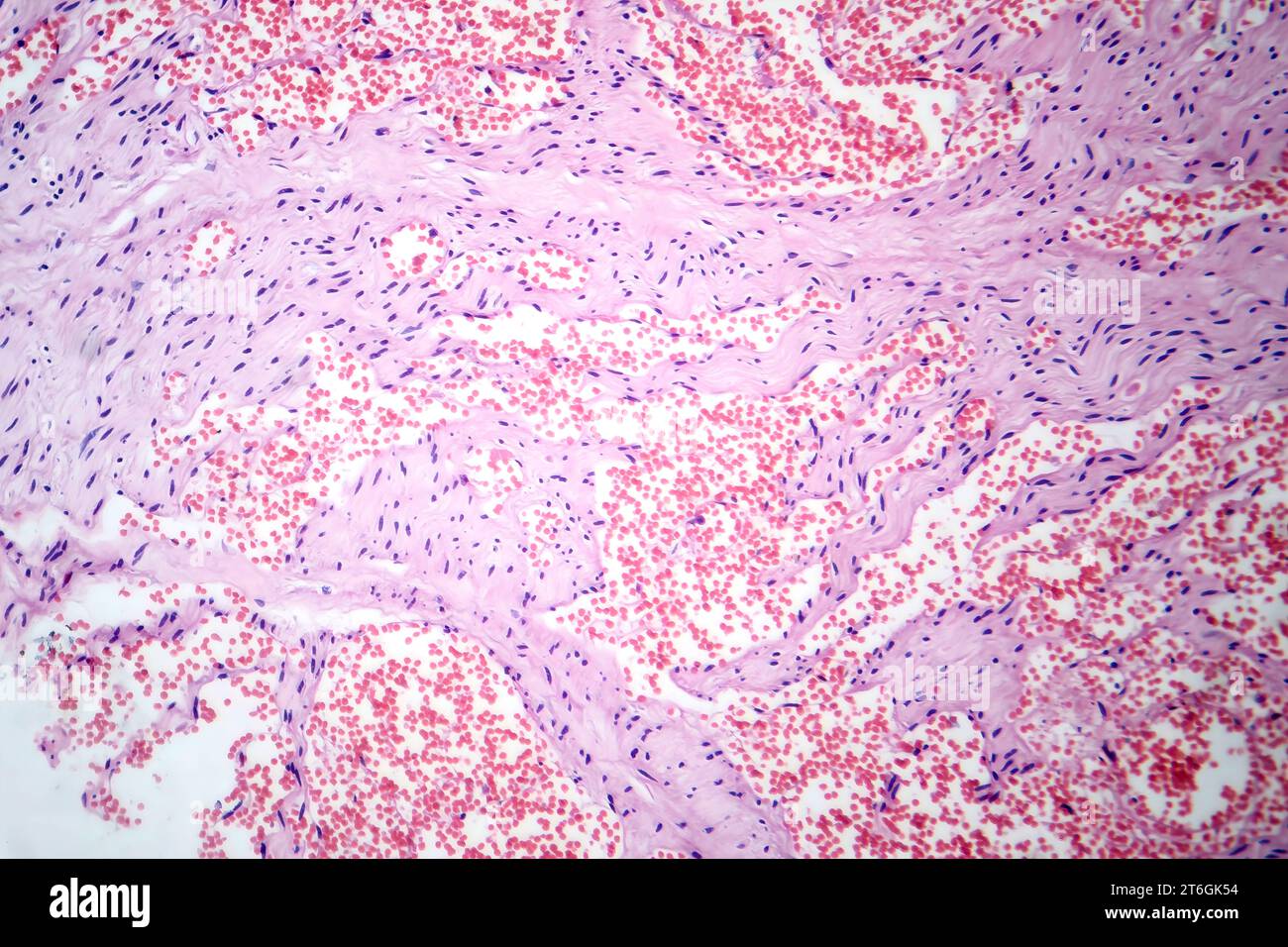 Photomicrograph of capillary hemangioma, illustrating abnormal ...