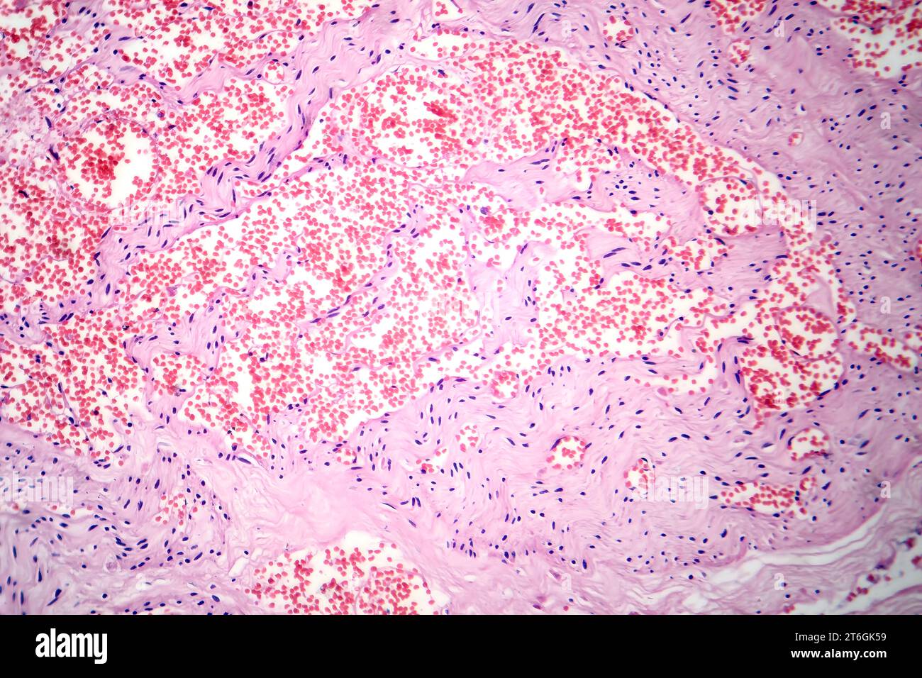 Photomicrograph of capillary hemangioma, illustrating abnormal ...