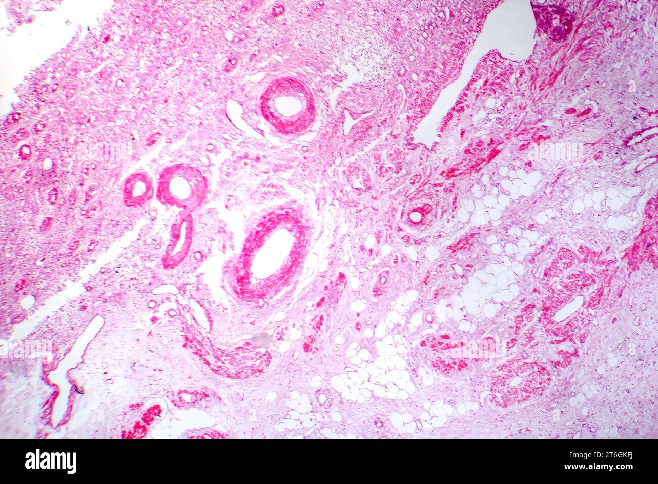 Photomicrograph of primary particulate contracted kidney, illustrating ...