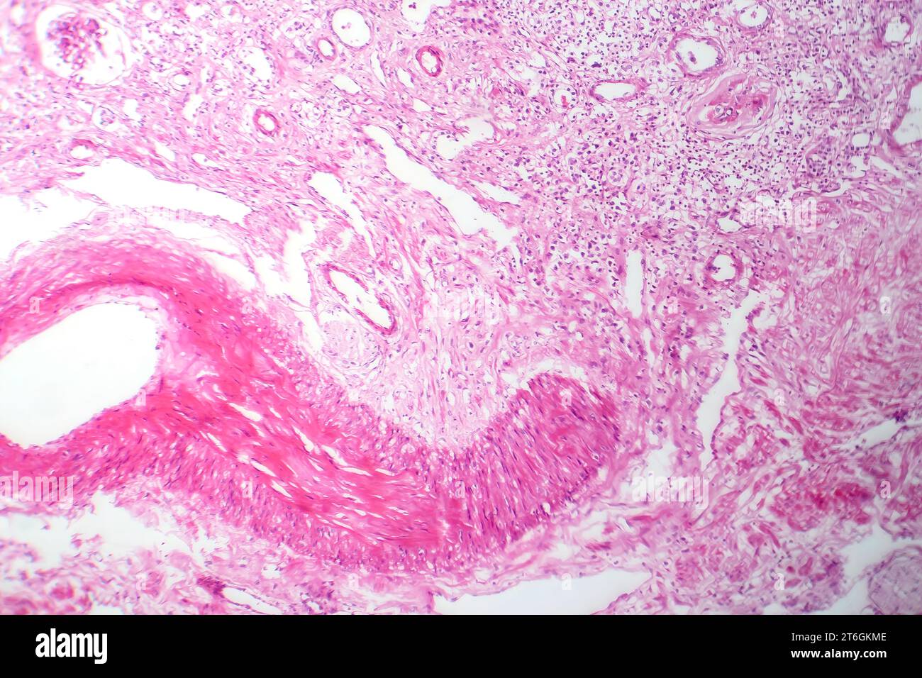 Photomicrograph of primary particulate contracted kidney, illustrating ...