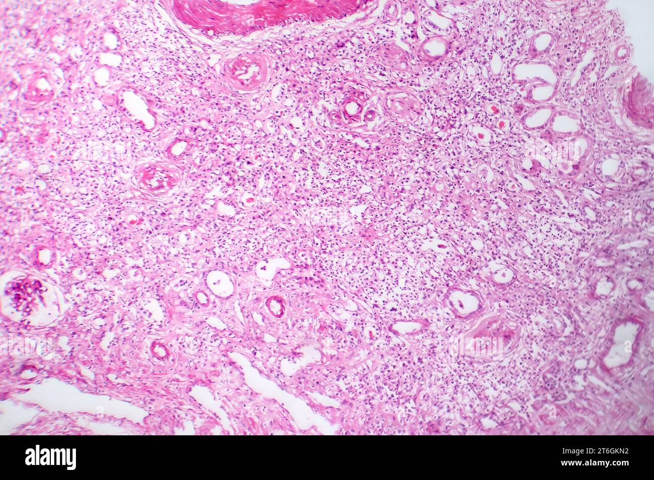 Photomicrograph of primary particulate contracted kidney, illustrating ...