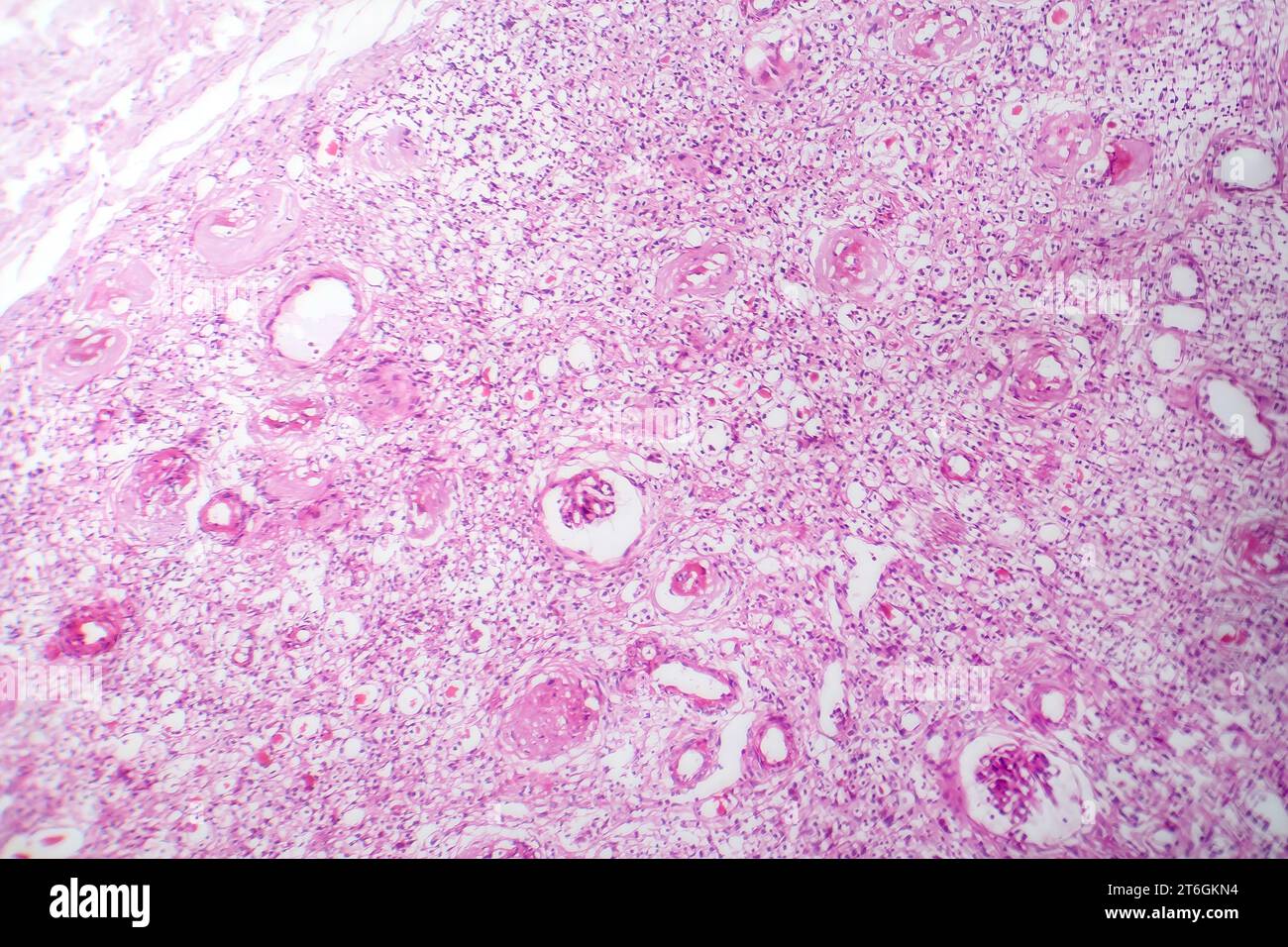 Photomicrograph of primary particulate contracted kidney, illustrating ... Photomicrograph of primary particulate contracted kidney, illustrating ...