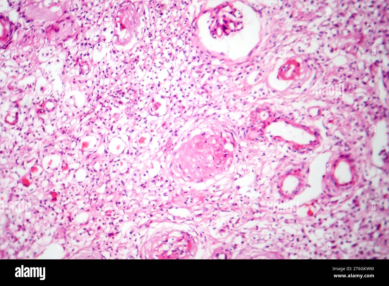 Photomicrograph of primary particulate contracted kidney, illustrating ...