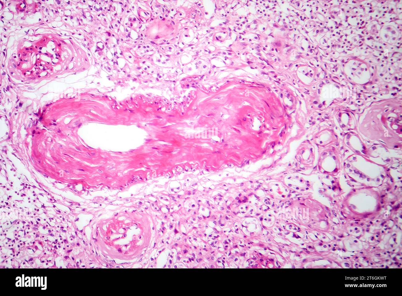 Photomicrograph of primary particulate contracted kidney, illustrating ... Photomicrograph of primary particulate contracted kidney, illustrating ...