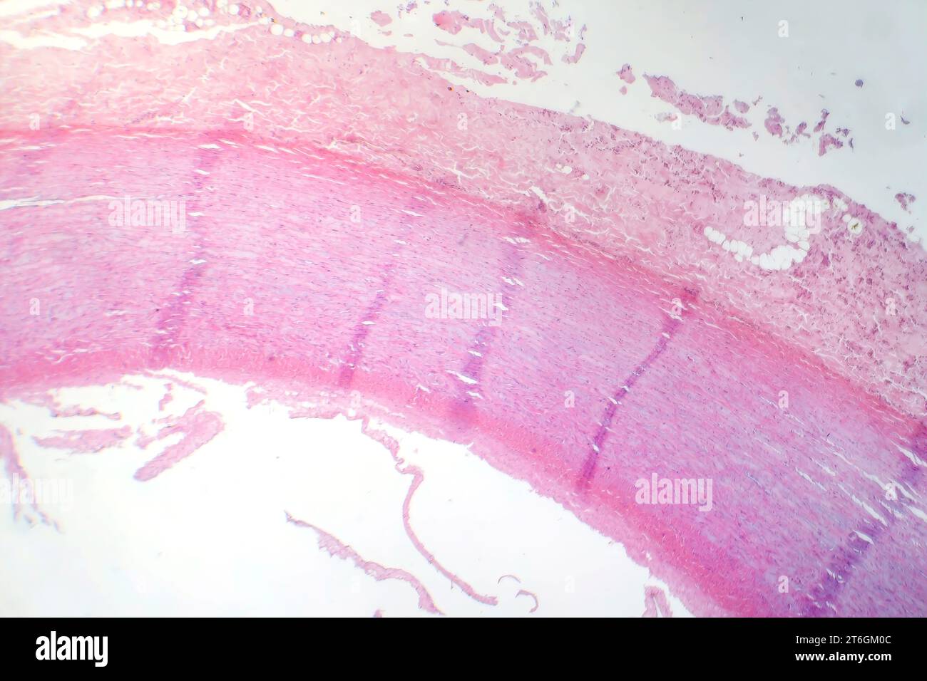 Photomicrograph of fibrinoid necrosis in a vessel wall, displaying ...