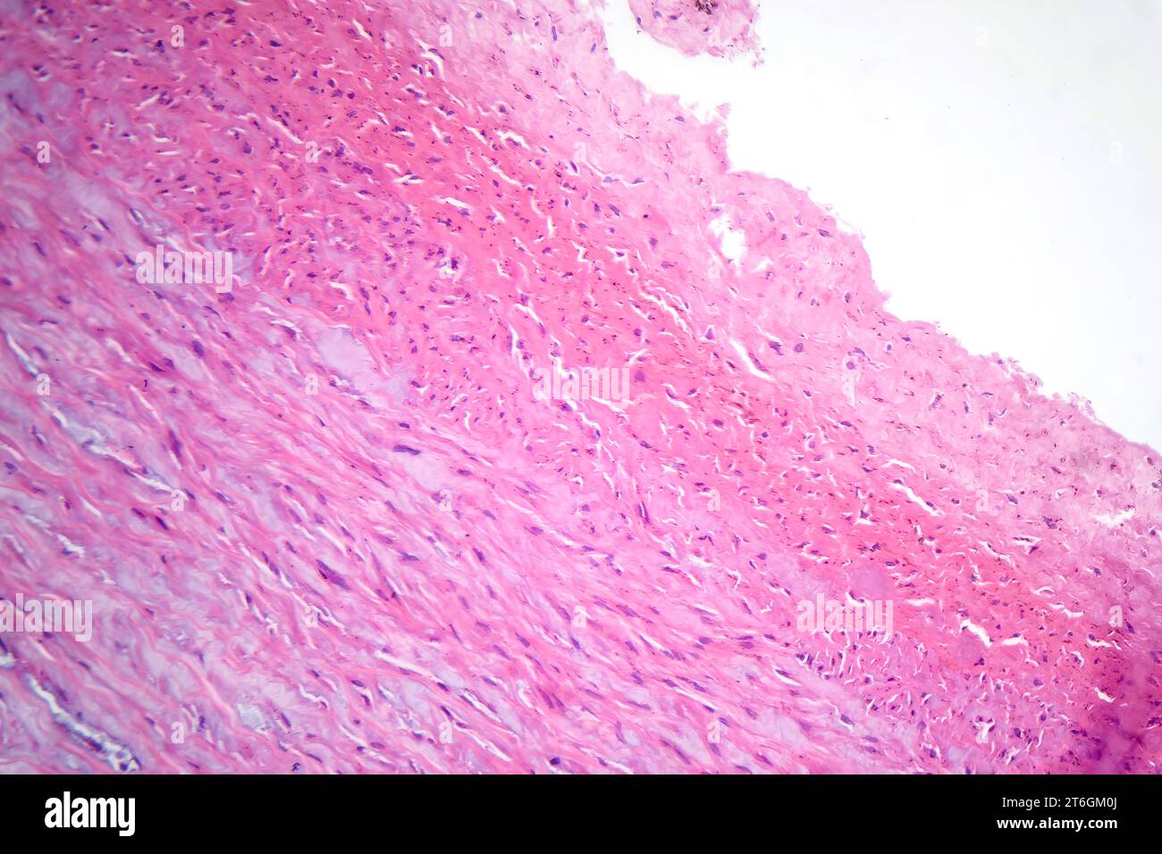 Photomicrograph of fibrinoid necrosis in a vessel wall, displaying ...