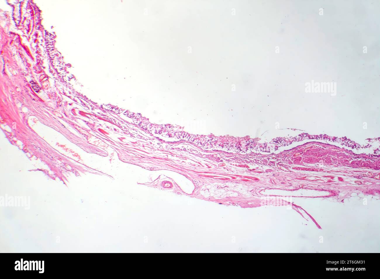 Photomicrograph of chronic bronchitis, showing inflamed bronchial ...