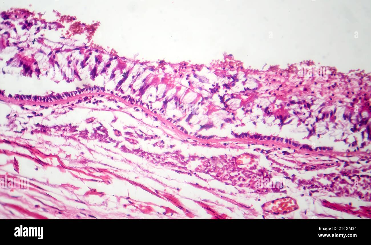 Photomicrograph of chronic bronchitis, showing inflamed bronchial ...