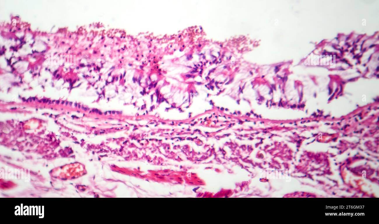 Photomicrograph of chronic bronchitis, showing inflamed bronchial ...