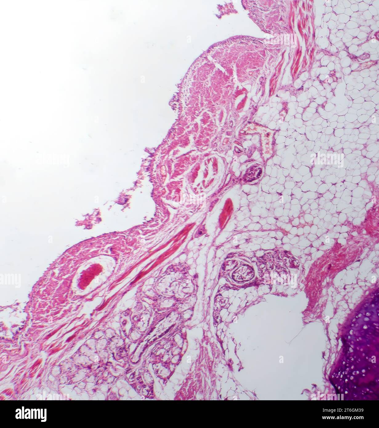 Photomicrograph of chronic bronchitis, showing inflamed bronchial ...