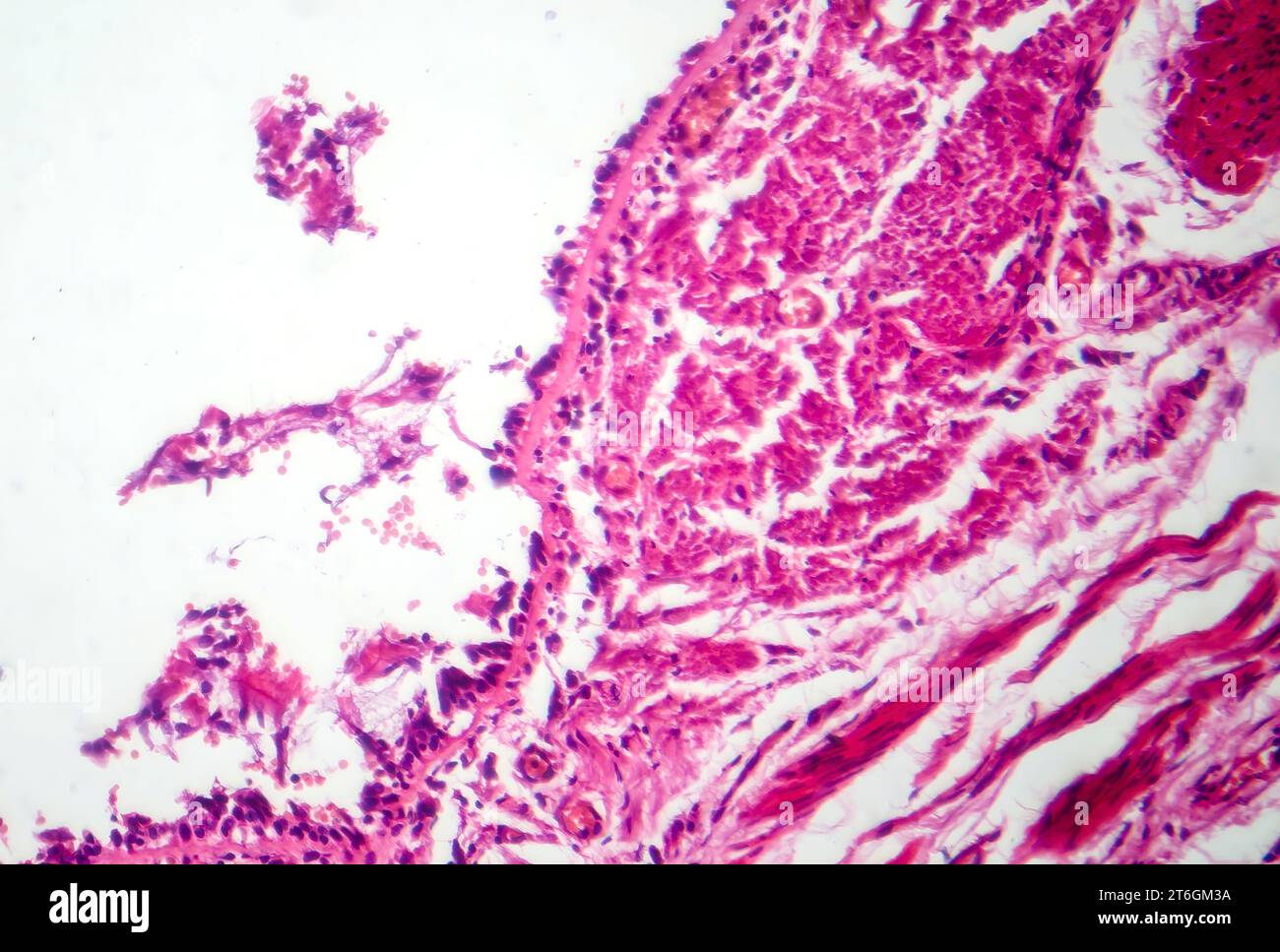 Photomicrograph of chronic bronchitis, showing inflamed bronchial ...