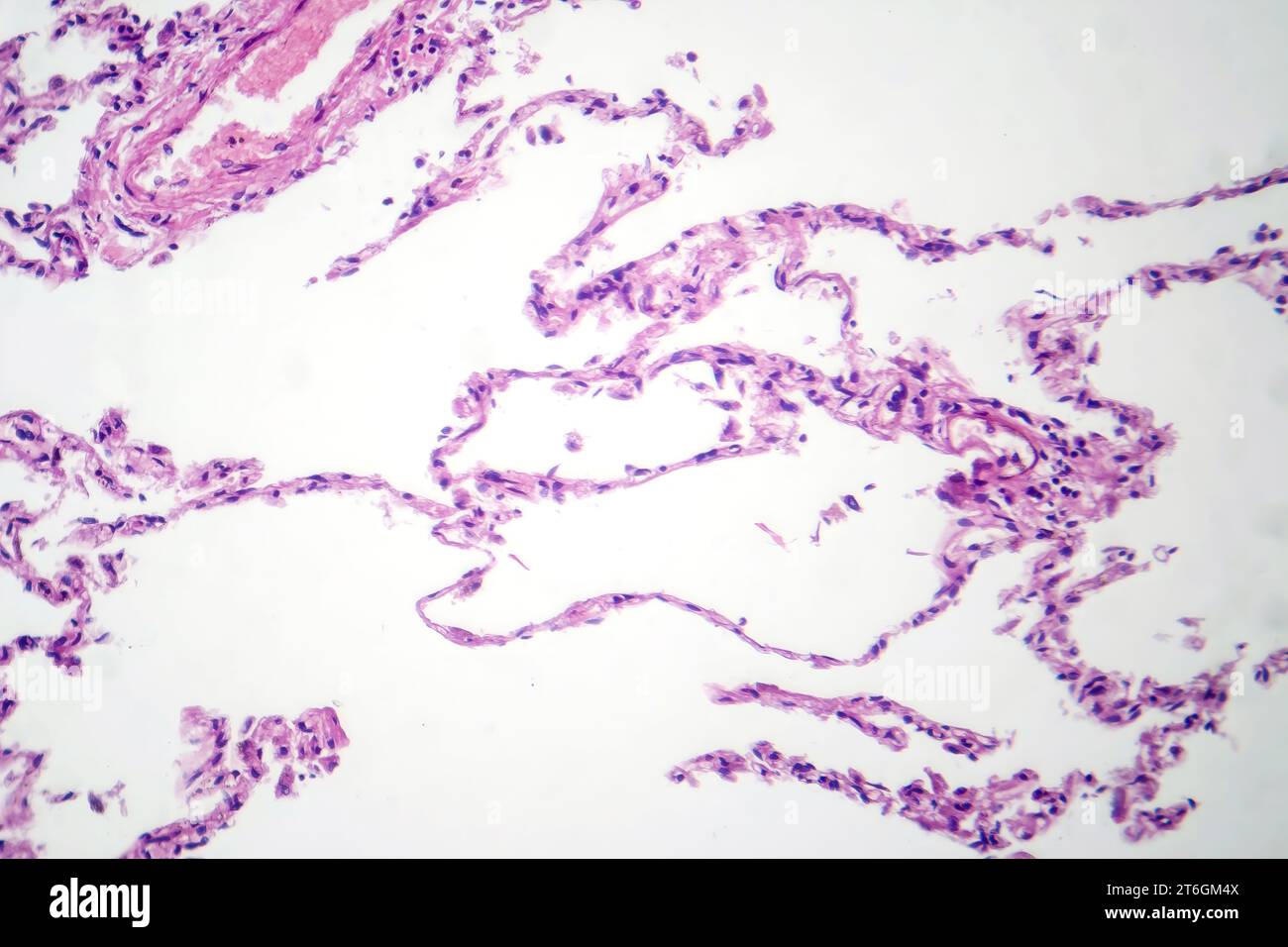 Photomicrograph of diffuse emphysema, revealing damaged lung tissue ...
