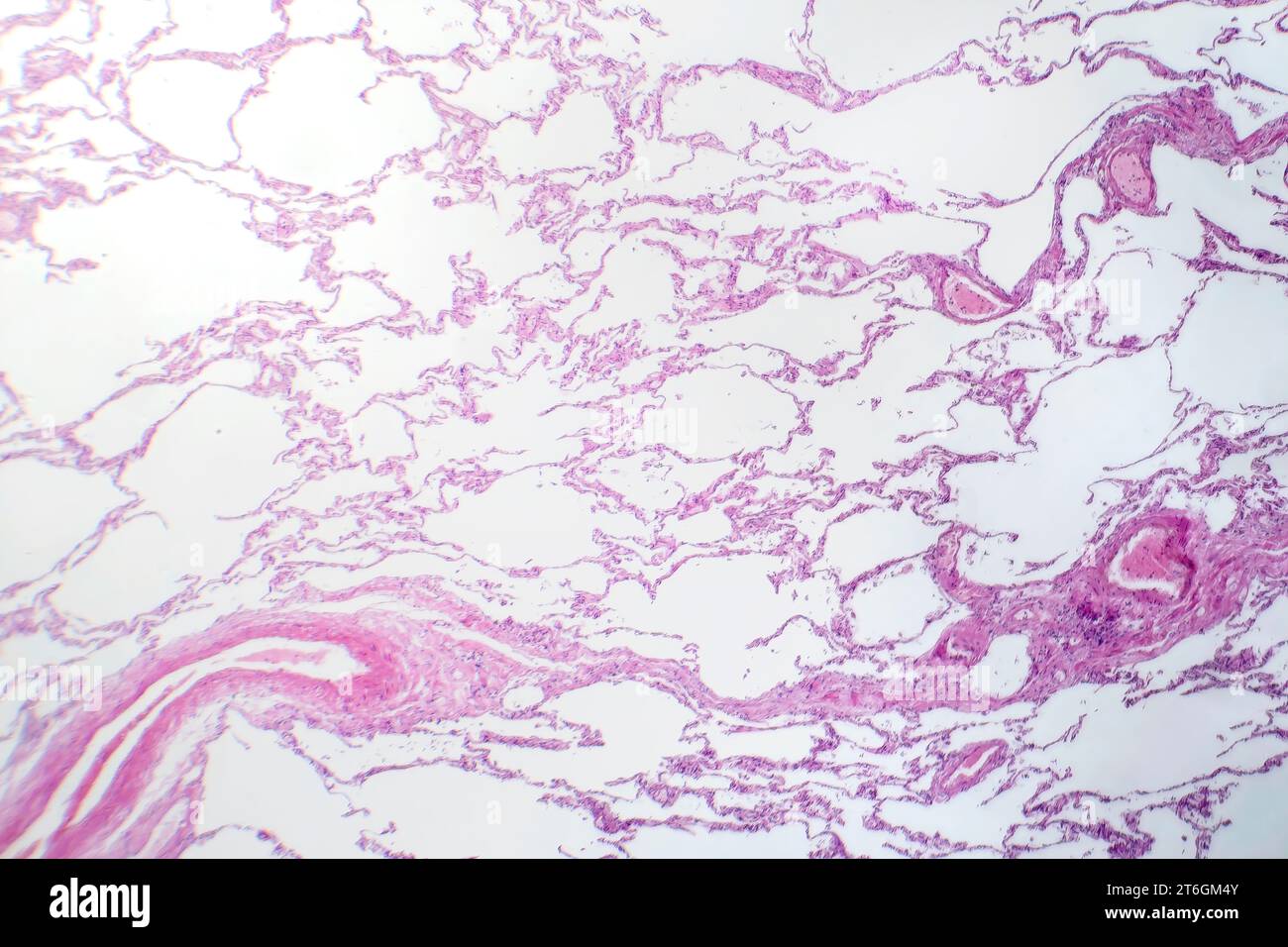 Photomicrograph of diffuse emphysema, revealing damaged lung tissue ...
