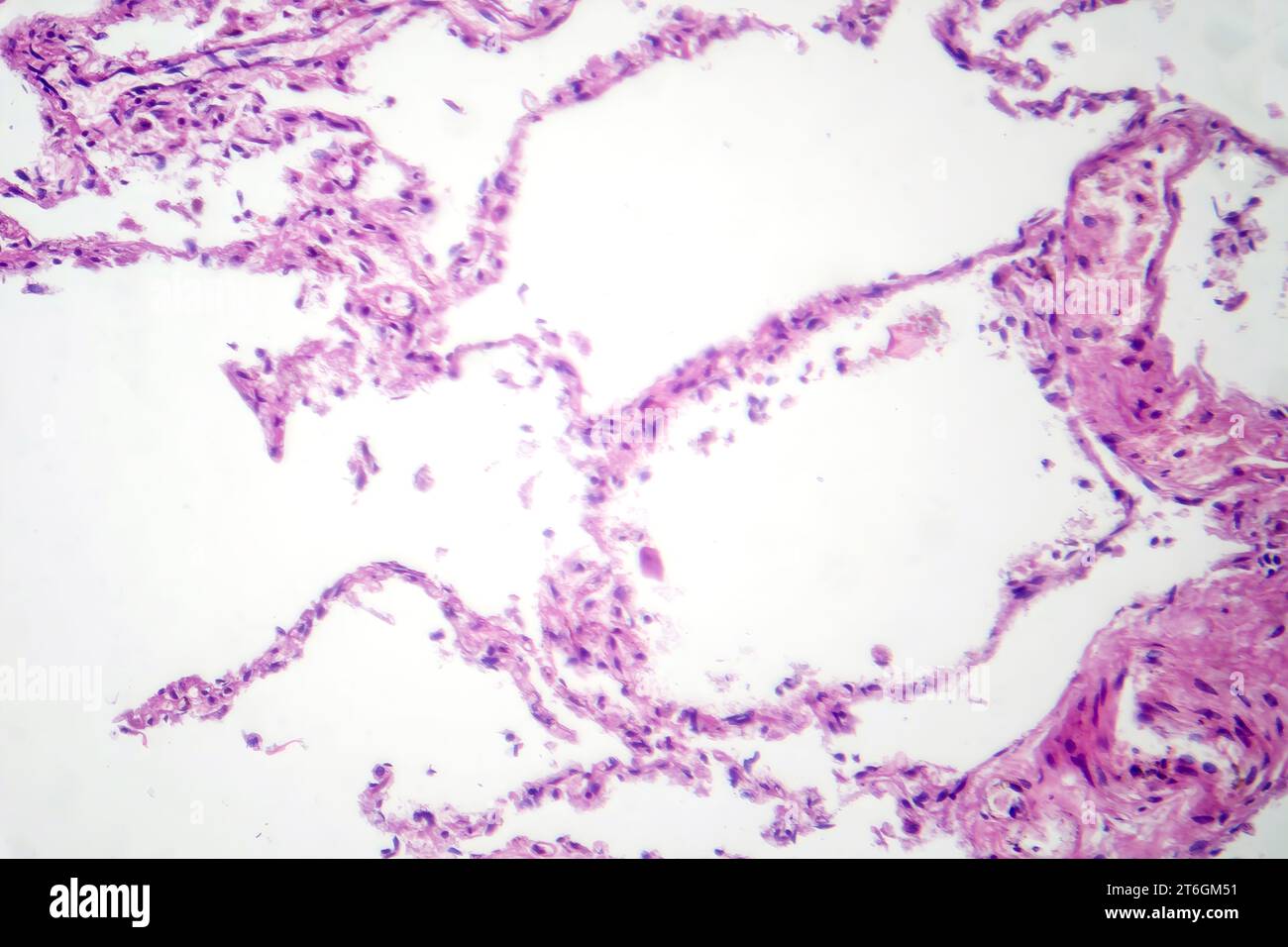 Photomicrograph of diffuse emphysema, revealing damaged lung tissue ...