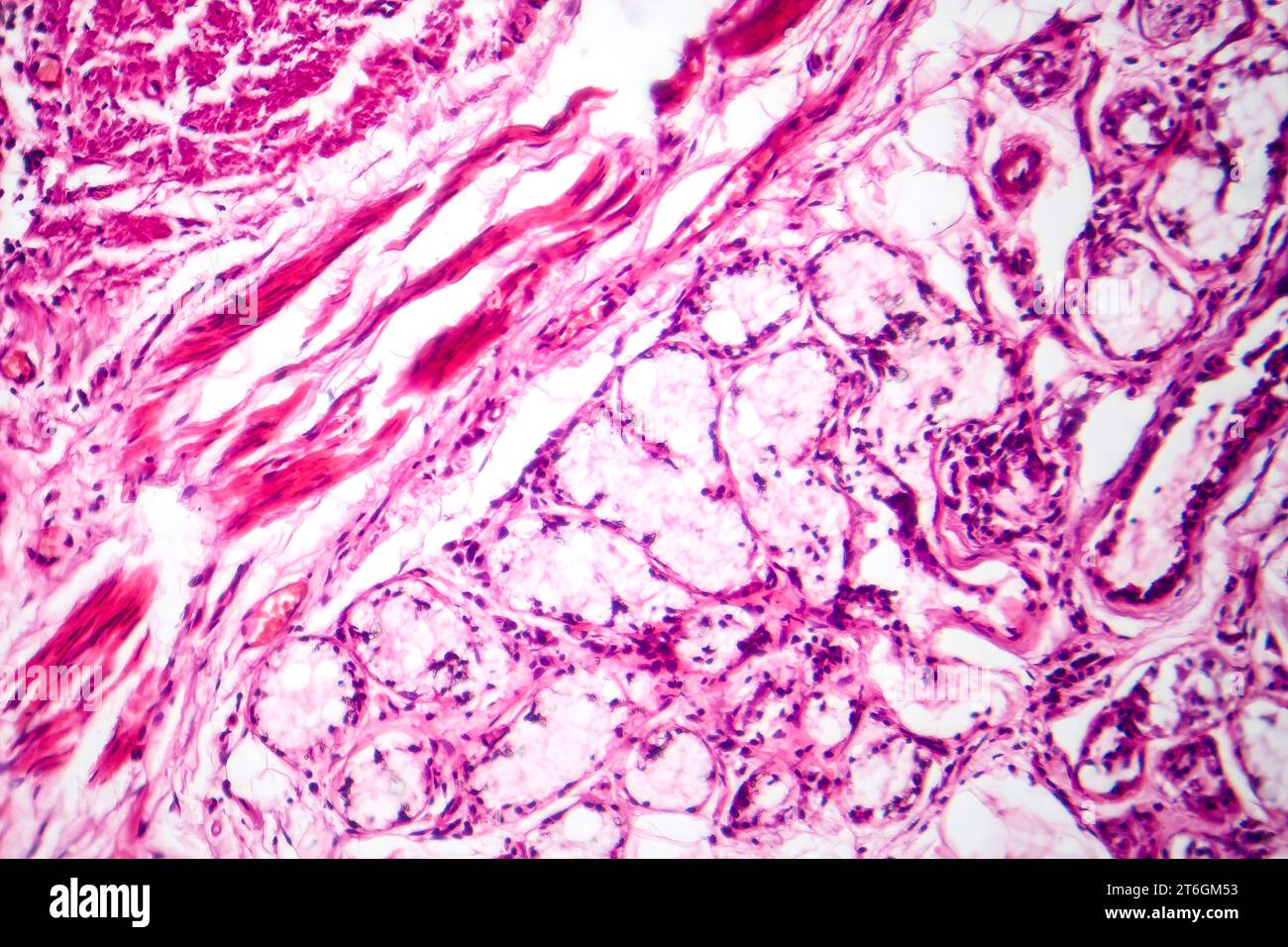 Photomicrograph of chronic bronchitis, showing inflamed bronchial ...