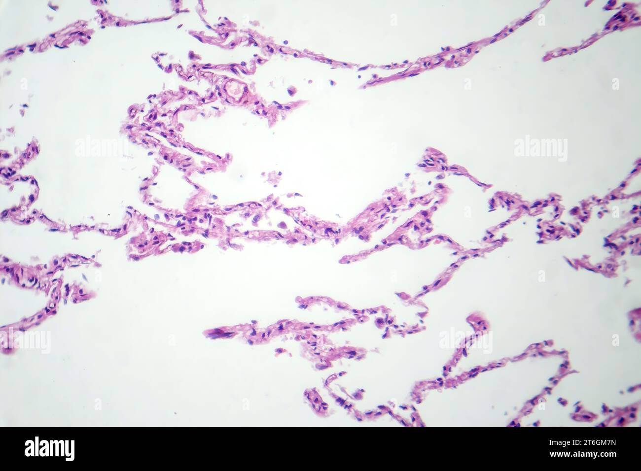 Photomicrograph of diffuse emphysema, revealing damaged lung tissue ...