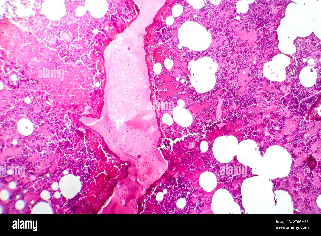Photomicrograph of lobar pneumonia during the hemorrhagic edema period ...