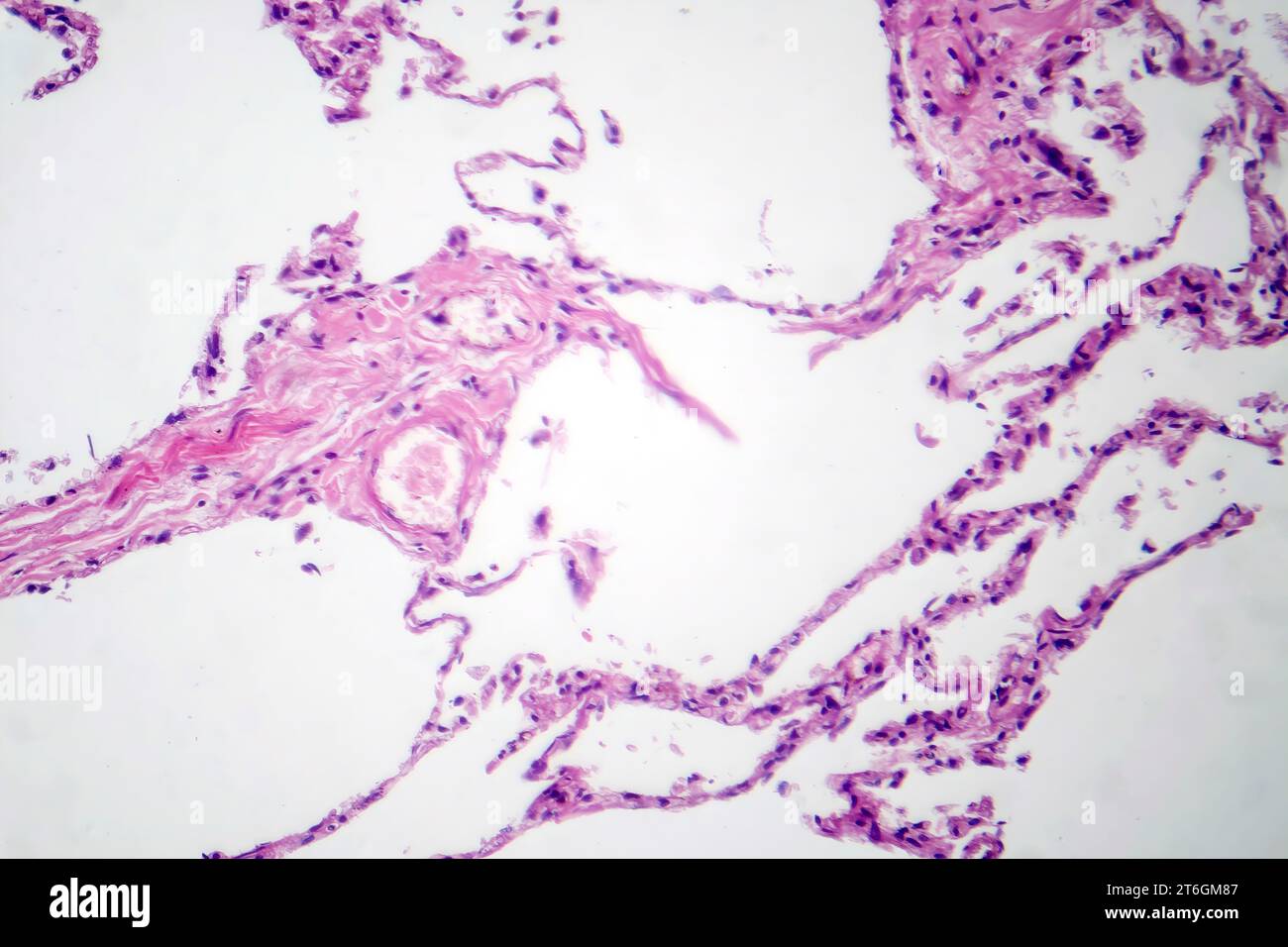 Photomicrograph of diffuse emphysema, revealing damaged lung tissue ...
