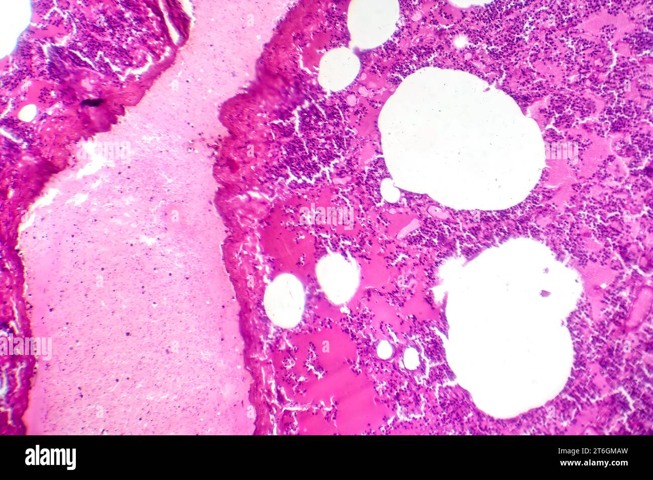 Photomicrograph of lobar pneumonia during the hemorrhagic edema period ...