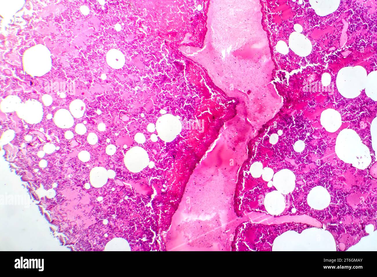 Photomicrograph of lobar pneumonia during the hemorrhagic edema period ...
