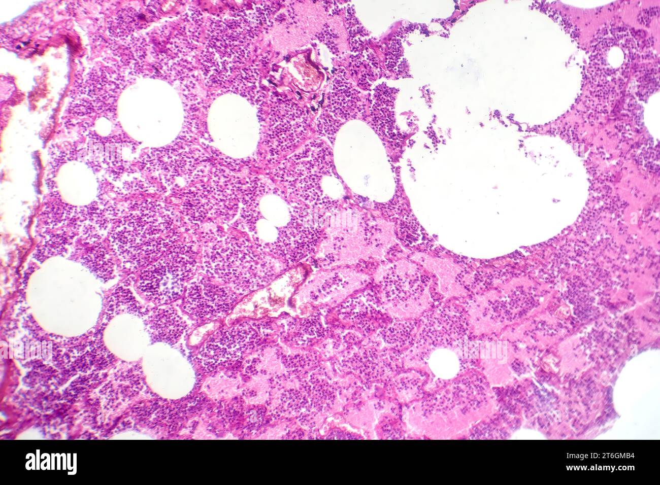 Photomicrograph of lobar pneumonia during the hemorrhagic edema period ...