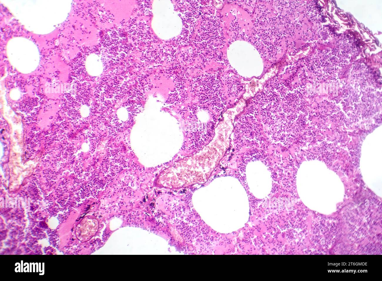 Photomicrograph of lobar pneumonia during the hemorrhagic edema period ...